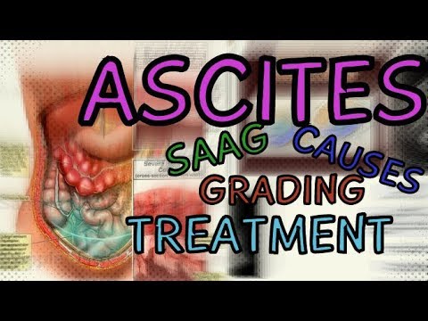 What are Ascites? Transudate vs Exudate - SAAG - Fluid Wave Test - Shifting Dullness - Treatment