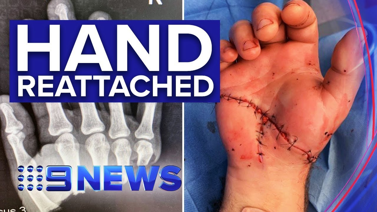 Man's severed hand reattached in rare surgery | Nine News Australia