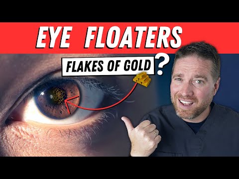Unique EYE FLOATERS! (Asteroid Hyalosis vs Synchysis Scintillans)