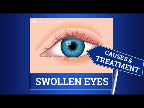 Swollen Eyelid: Causes & Treatment