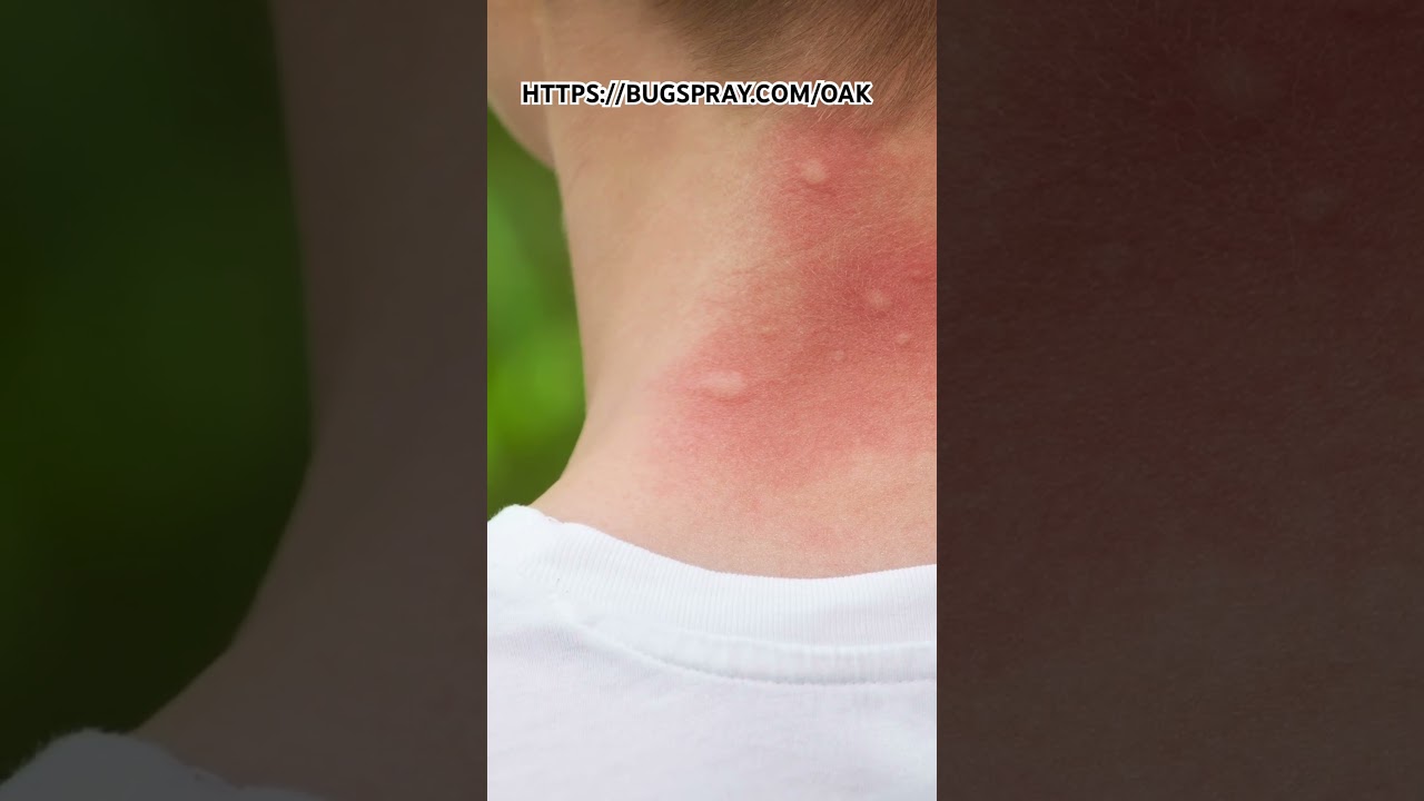 OAK ITCH MITES - How to Control and Treat | https://bugspray.com/oak