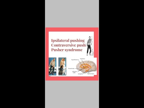 pusher syndrome contraversive pushing ipsilateral pushing #stroke #thalamus