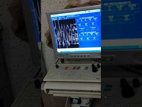 BERA Test (brainstem evoked response audiometry)