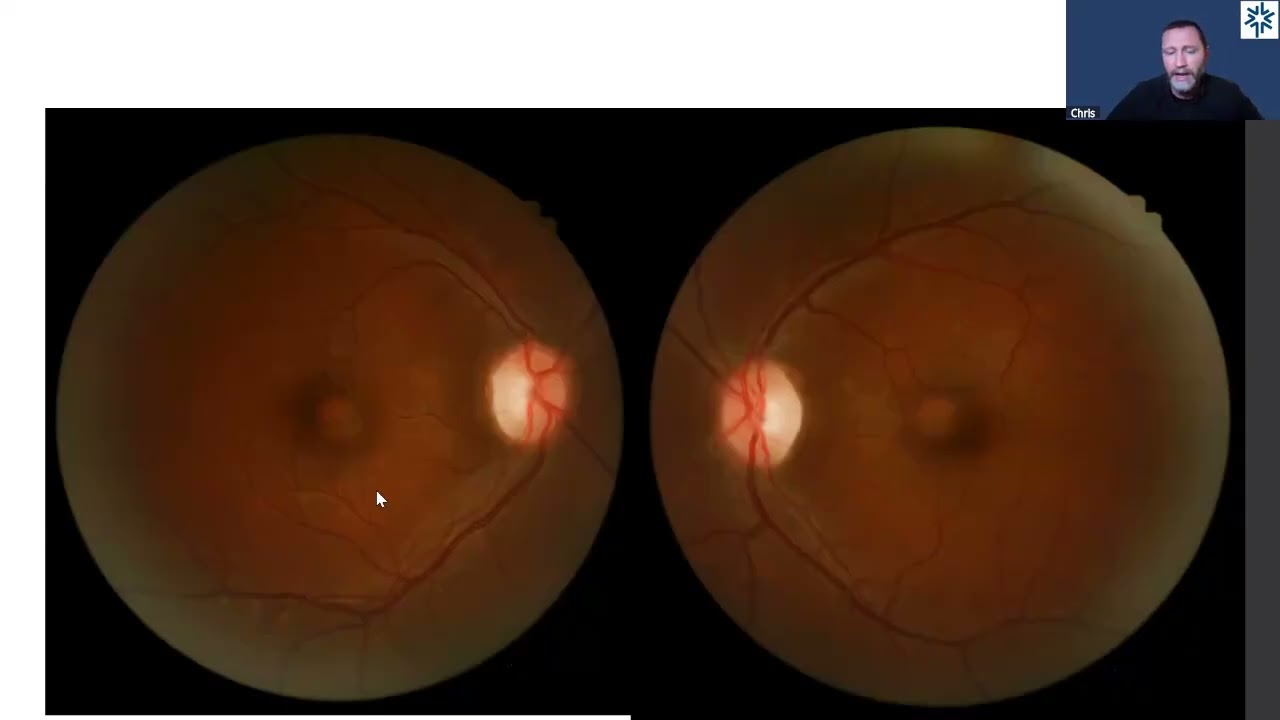 Neuro Eye Grand Rounds: My Favorite Cases