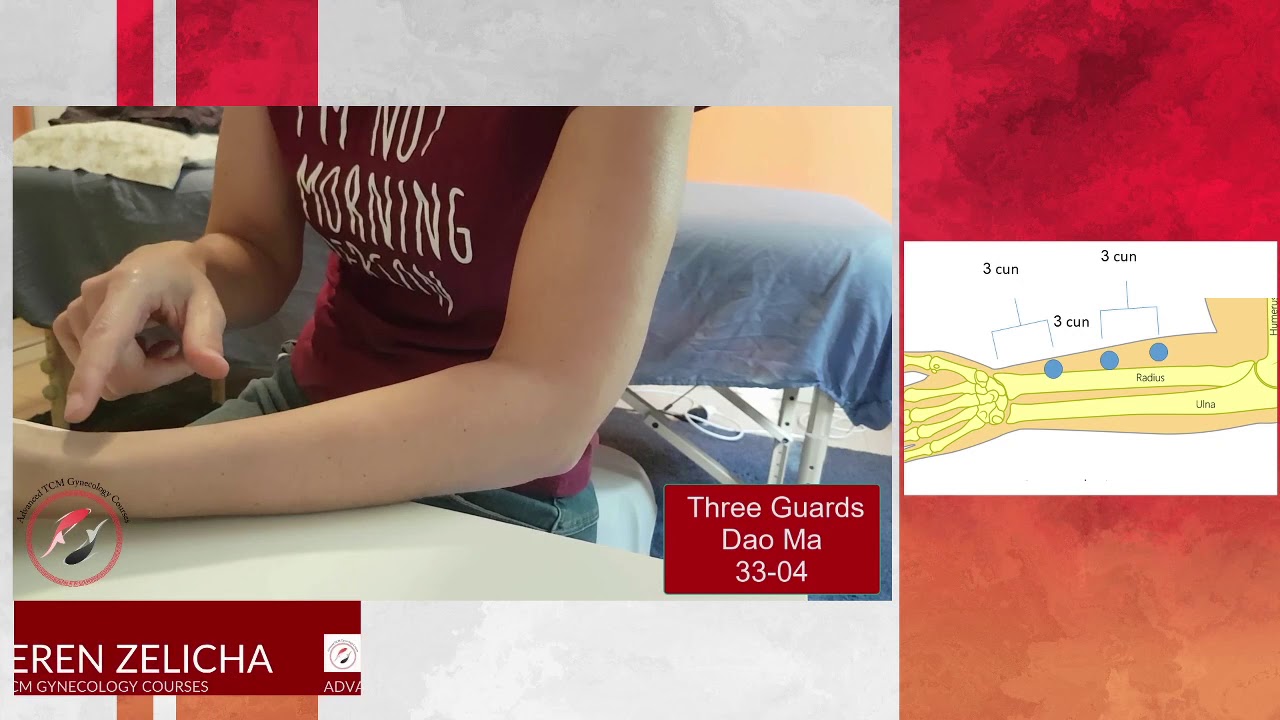 Tung's Acupuncture points 33.13 (Ren shi), 33.14 (Di shi), 33.15 (Tian shi)