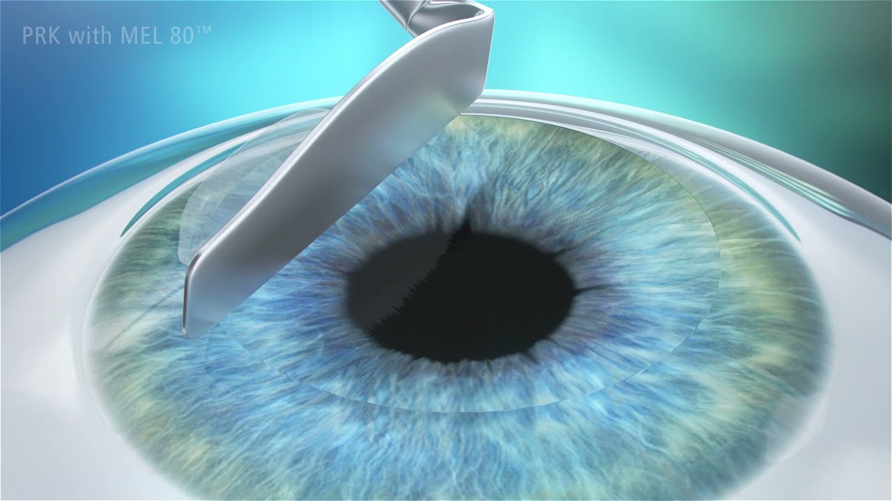PRK  Carl Zeiss Meditec