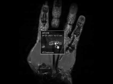 Stenosing tenosynovitis - Trigger finger