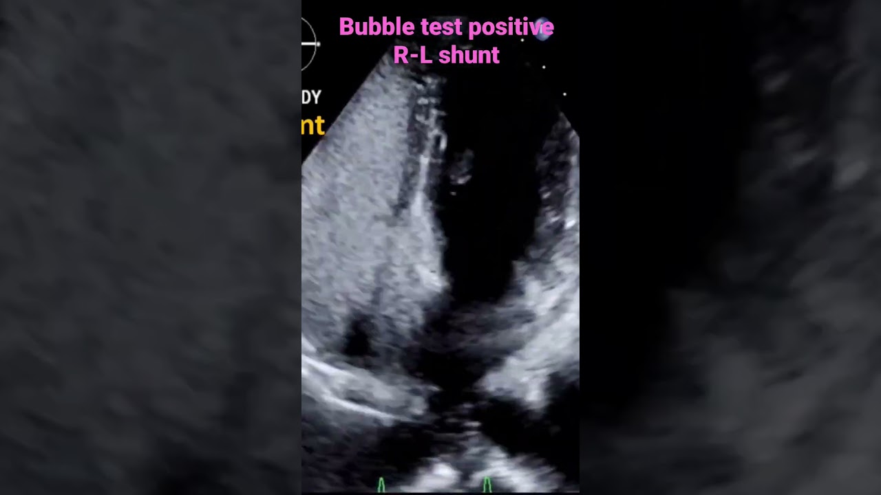 Positive bubble test L-R shunt