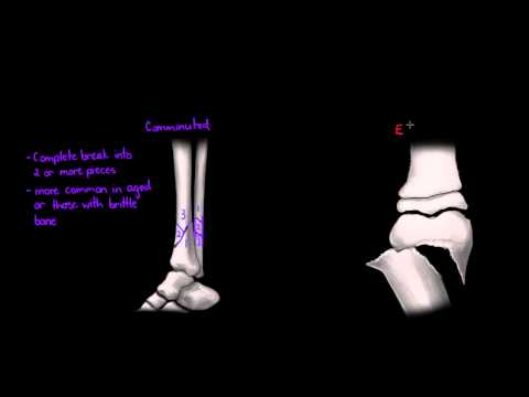 Bone Fractures