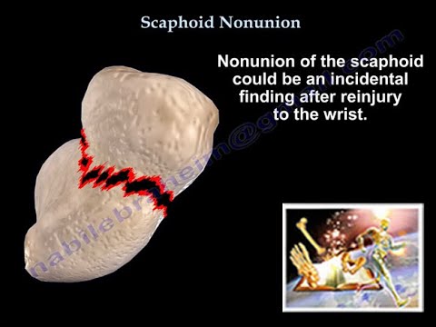 Scaphoid Nonunion – Dr. Nabil Ebraheim's Blog