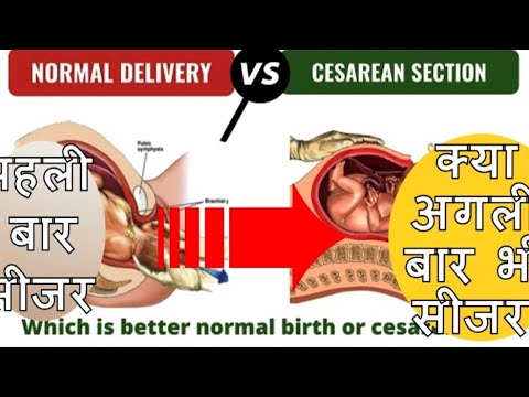 CESAREAN SECTION- Unveiled: Expert Insights on What, Why, & When You Need It!