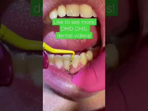 What are your measurements? #periodontalprobe #dentist #dentalhygienist #dentalstudent #oralhealth