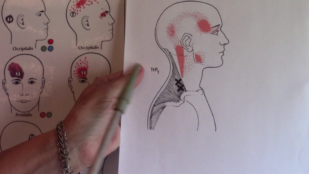 Trigger Point Chart Explained