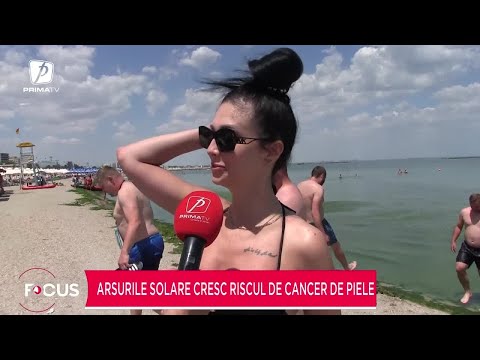 Arsurile solare cresc riscul de cancer de piele. Caniculă și la malul mării