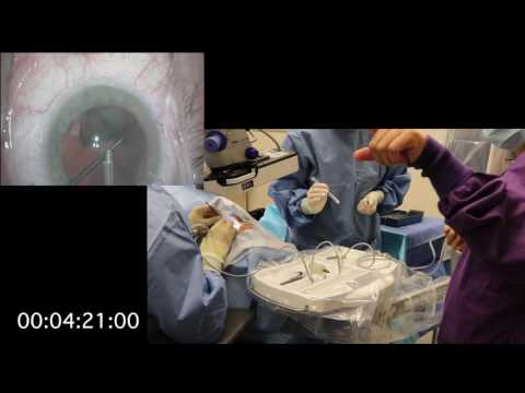 Surgical assistant/Scrub Technician training for Cataract surgery (CD) 8-10-16
