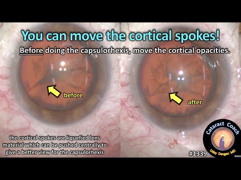 CataractCoach 1339: you can move cortical spokes
