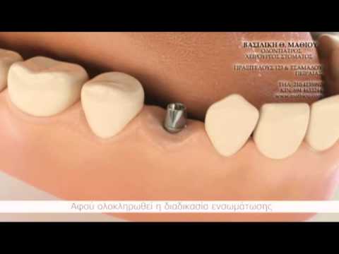 ΤΟ ΟΔΟΝΤΙΑΤΡΙΚΟ ΕΜΦΥΤΕΥΜΑ ΣΤΗΝ ΚΛΙΝΙΚΗ ΠΡΑΞΗ | Μπόρας Ευάγγελος