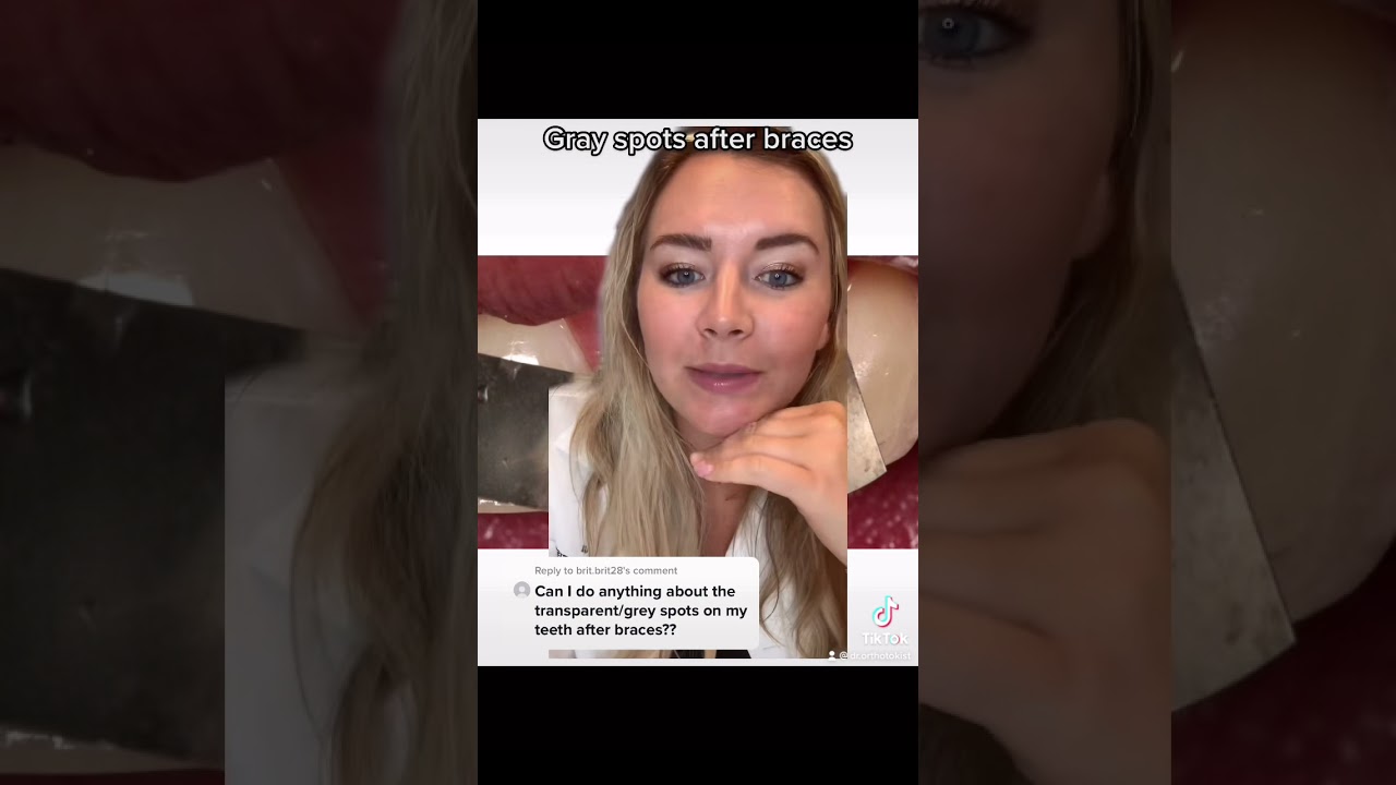 Gray spots on braces #shorts #braces