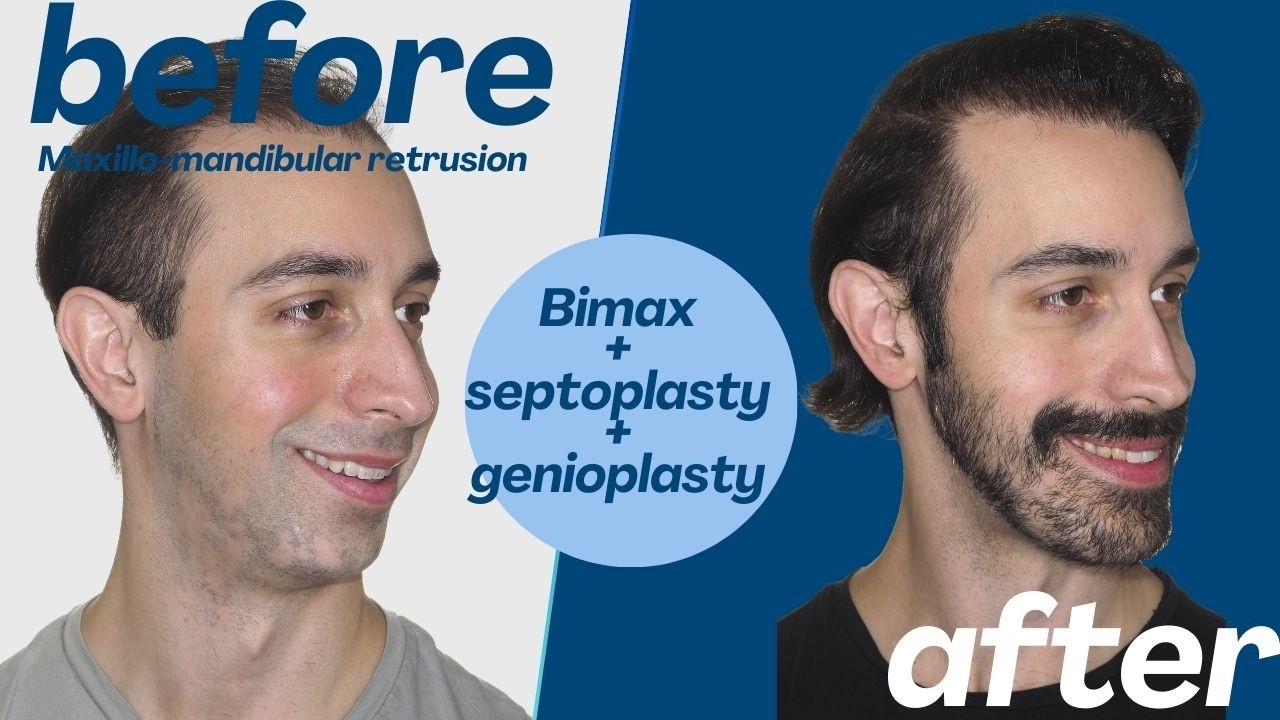 Bimaxillary Surgery Case #161: Gianni | Maxillo-Mandibular Retrusion & Airway Correction