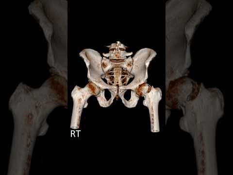 xray Pelvis and hip- Intracapsular fracture neck of femur left hip.