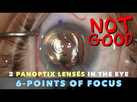 FIXING a poor result AFTER Cataract Surgery | 2 Panoptix Lenses in the SAME EYE | IOL Exchange