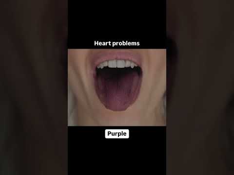 Signs of Tongue colour #tongue #health #oralhealth #doctor #drsparshsingh