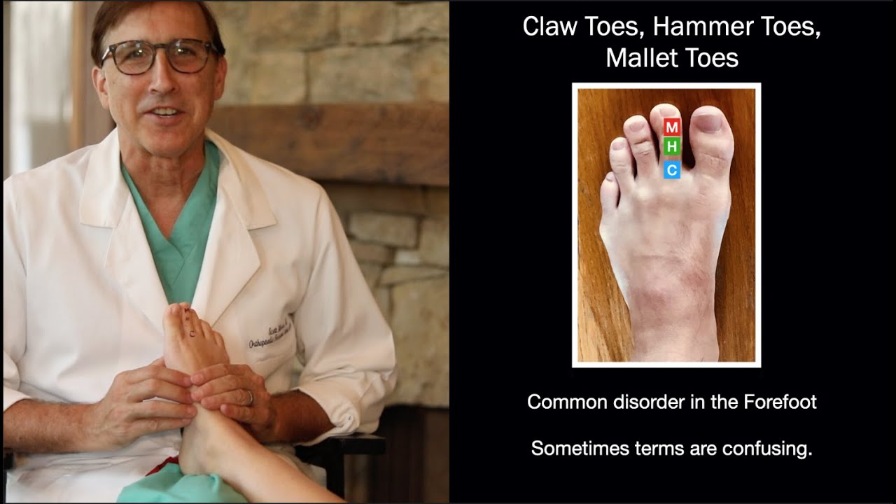 Claw Toe, Hammer Toe, Mallet Toe