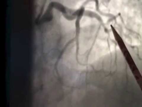 Transradial Coronary Stent Placement