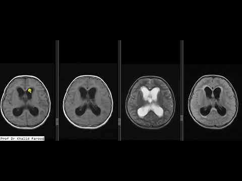 mri brain craniopharyngioma