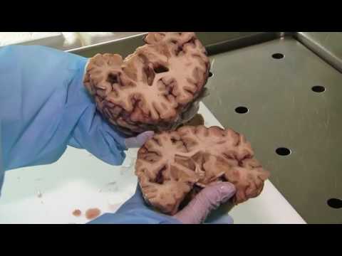 New study shows link between football hits and CTE