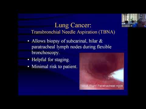 Lung Cancer, Pulmonologist's Perspective