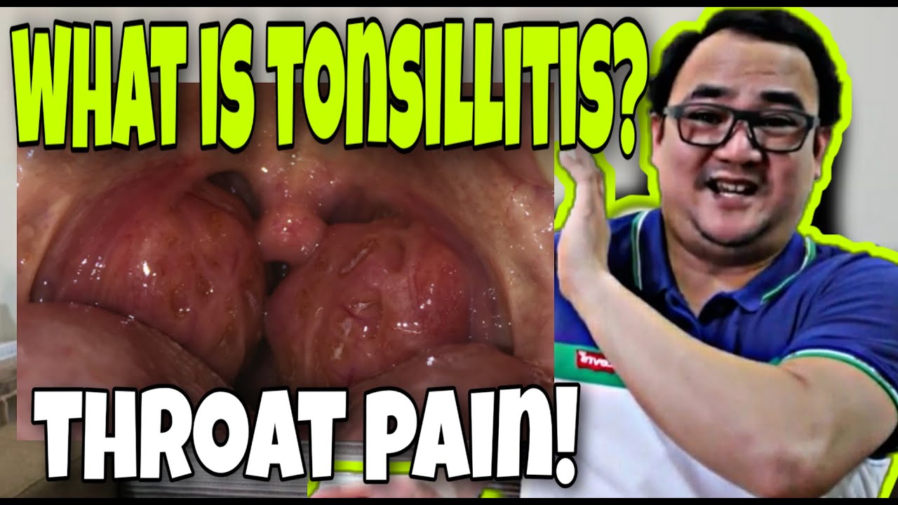 What is Tonsillitis?