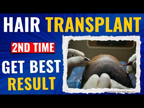 Dr VISHWAJIT Rajput's LIFE CHANGING Hair Transplant Surgery