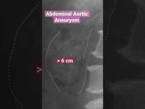 Abdominal Aortic Aneurysm #xray #radiology #chiropractic
