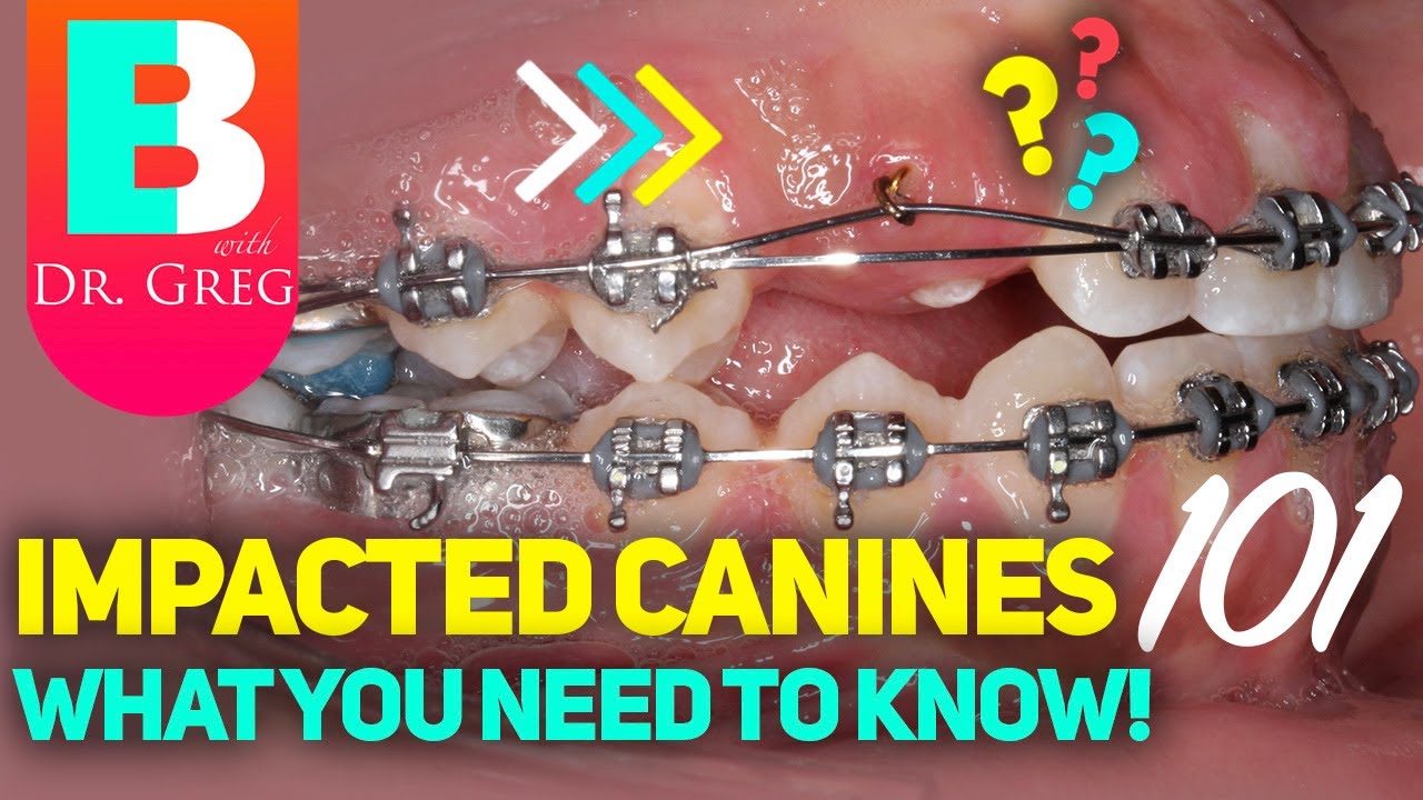 Braces and Impacted Canines