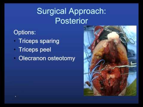 Distal humerus fractures - 1
