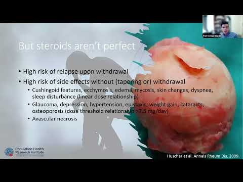 Management of ANCA vasculitis with Kidney involvement