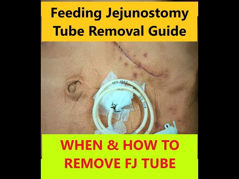 Feeding Jejunostomy Tube – How & When to Remove . All You Need to Know About FJ Tube.