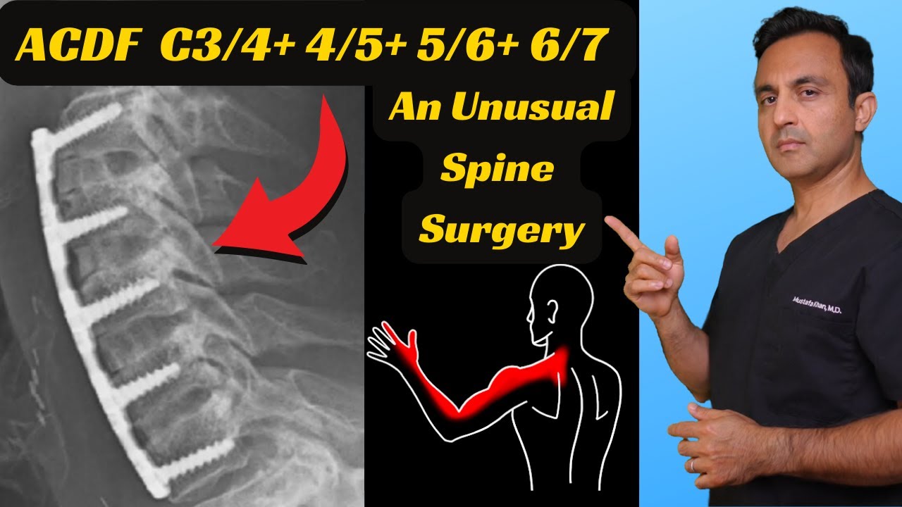 FOUR-level ACDF surgery: How it's done