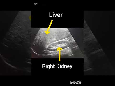 Ultrasound abdomen!Liver!Rt Kidney!#ultrasoundmadeeasy86#radiology#sonography#viralshorts#usa#uk#uae