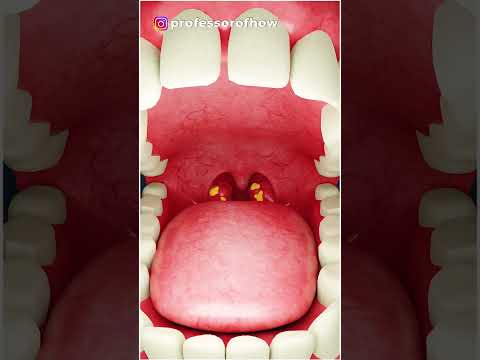 Tonsil Stones?😱 But WHY do you have those? - By Kishor Singh #shorts