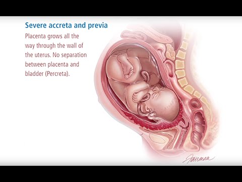 Introduction to Placenta Accreta Video - Brigham and Women's Hospital
