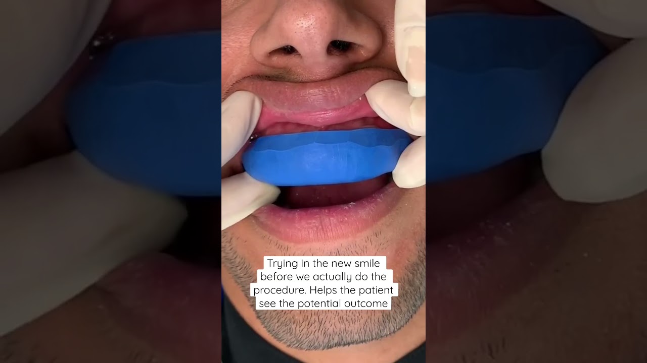 Trial smile veneers | porcelain veneers procedure | porcelain veneers for gapped teeth | Dr. Yazdan