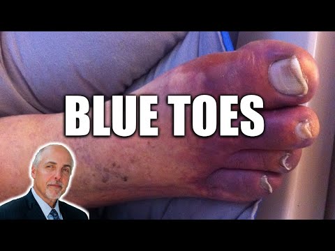 Blue Toes - A Clinical Approach