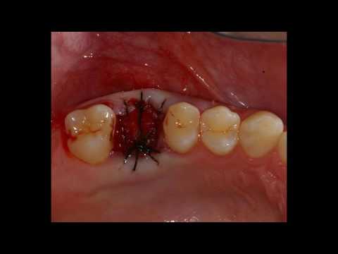 Webinar Replay: 12/6/16 Extraction and Grafting Techniques - Dr. Ara Nazarian