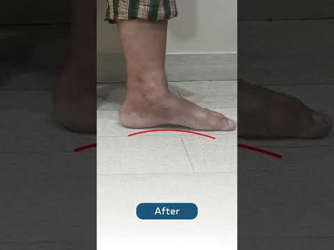Arched up and ready to run! Say goodbye to flat foot pain. #amblefootandanklecentre #flatfoot