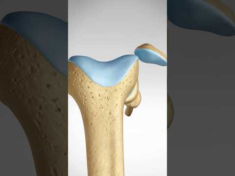 What happens when you dislocate your Knee Cap (MPFL Tears and Reconstruction) #kneeanatomy
