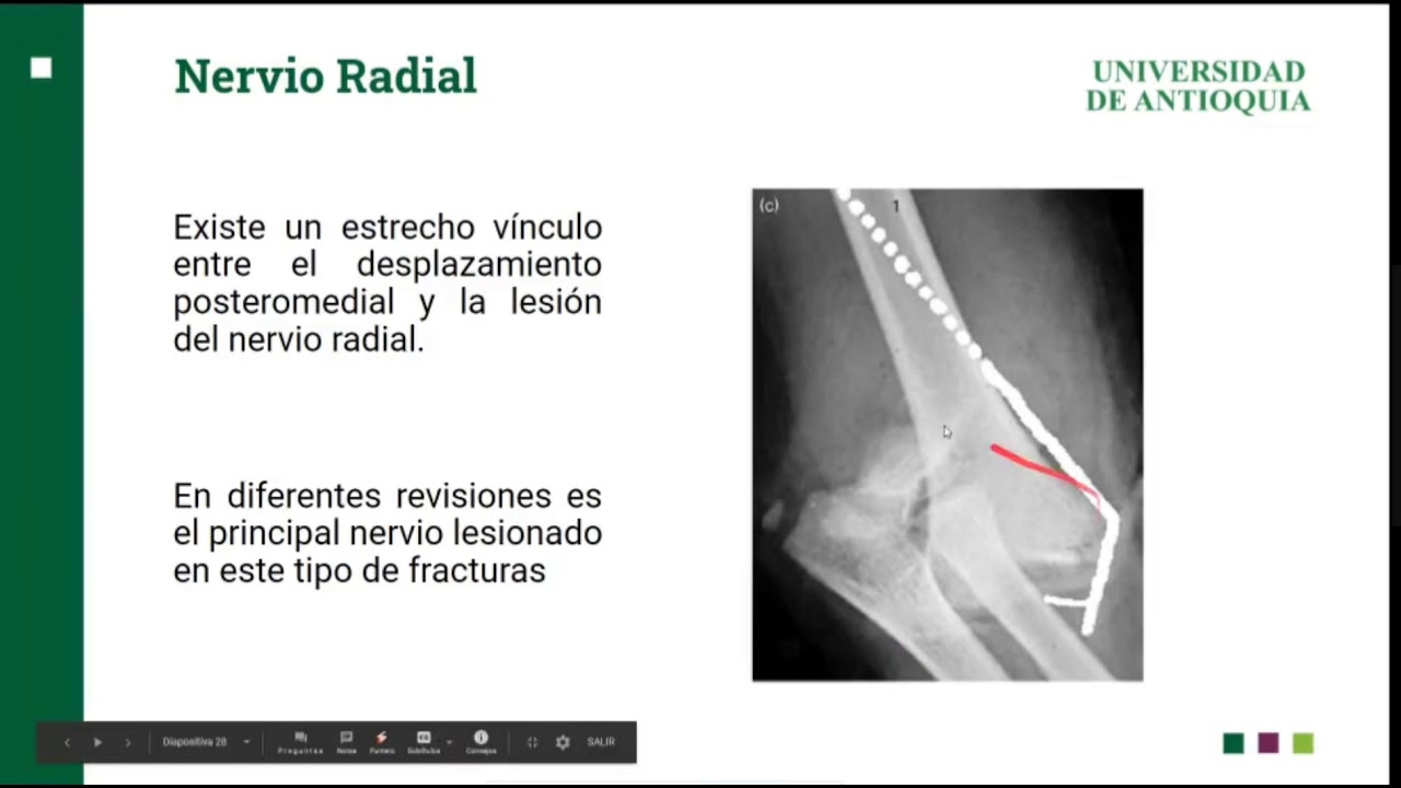 Complicaciones de las Fracturas supracondileas en niños. Dr Juan David Hernandez