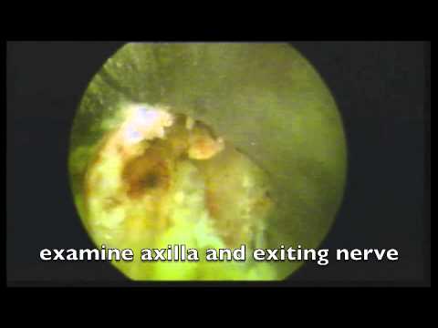 Foraminal Stenosis in L3-4 with Herniated Disc