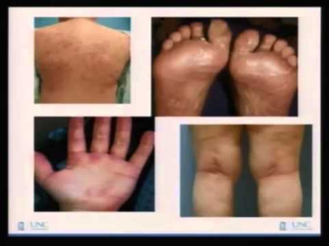 Managing Common Side Effects Mary Dunn, RN, MSN, OCN, NP-C